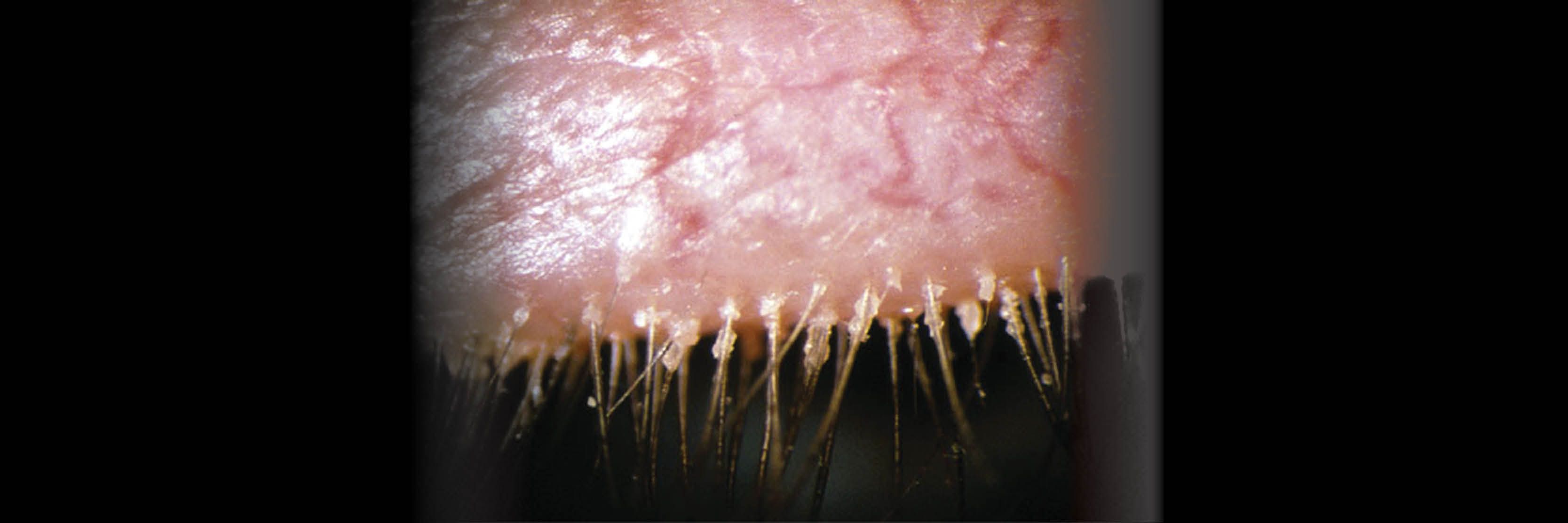 Swollen eyelids? You could be suffering from Blepharitis | Spectacle ...